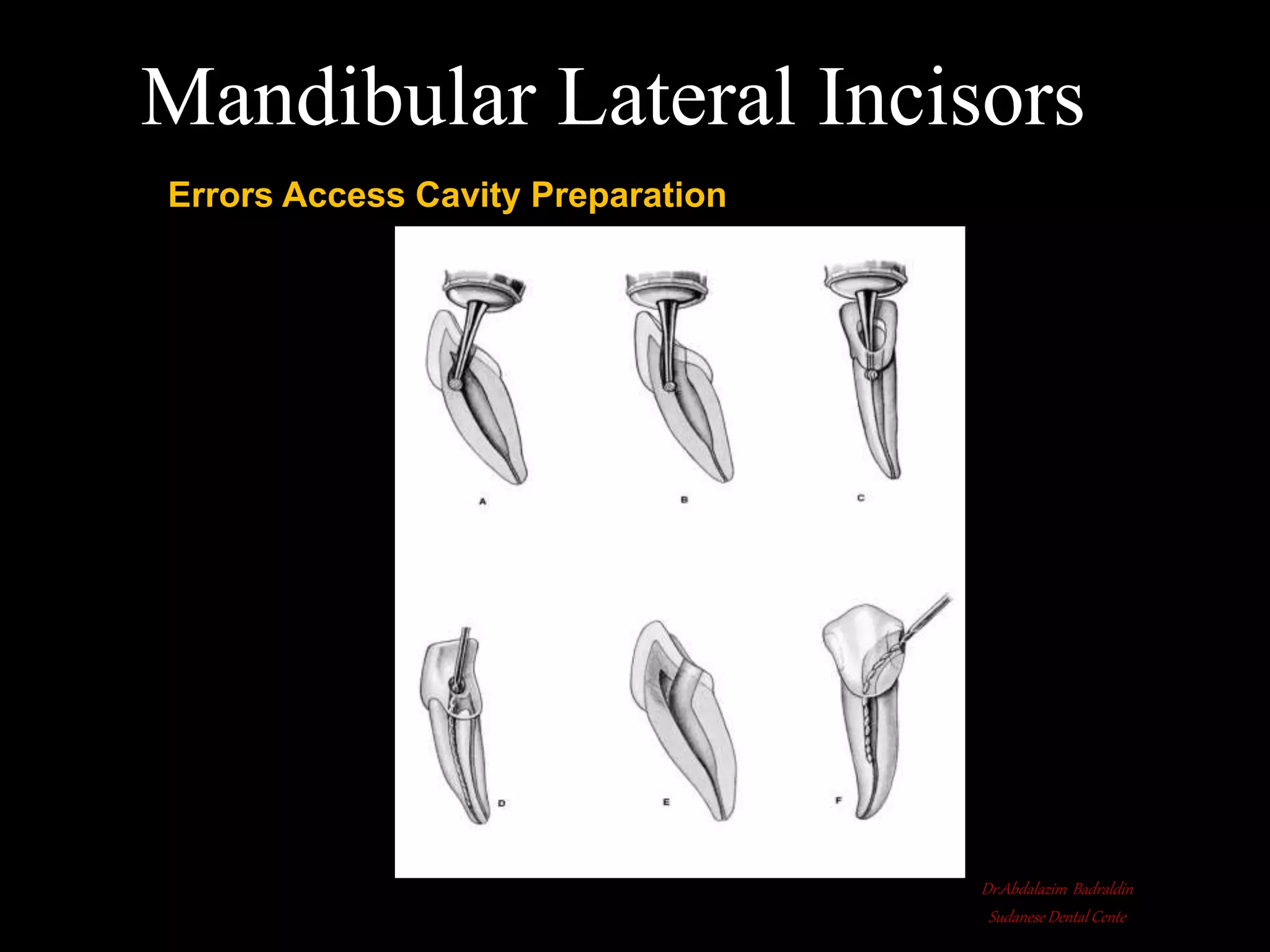 Root canal anatomy and configuration project mandibular teeth ...
