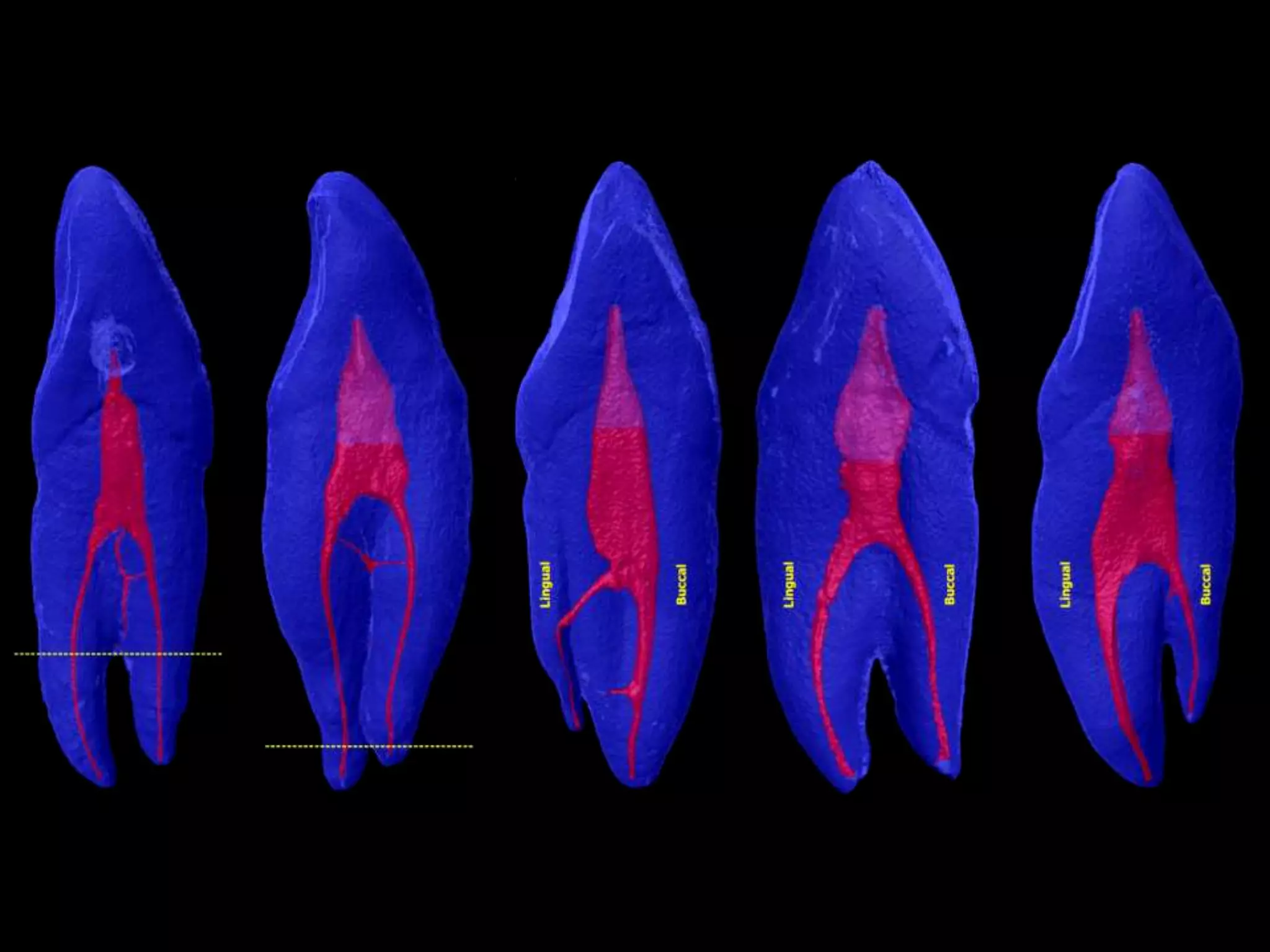 Root canal anatomy and configuration project mandibular teeth ...