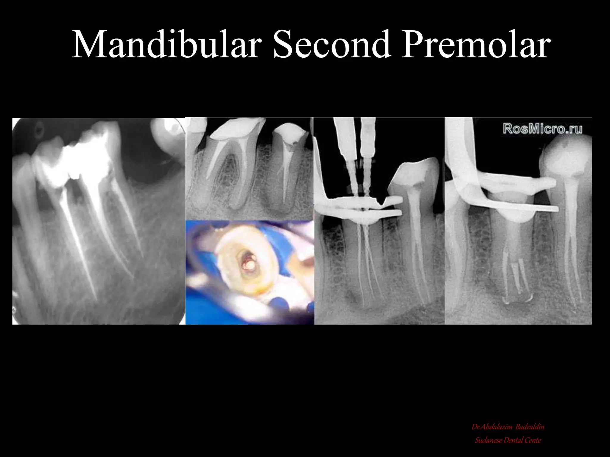Root canal anatomy and configuration project mandibular teeth ...