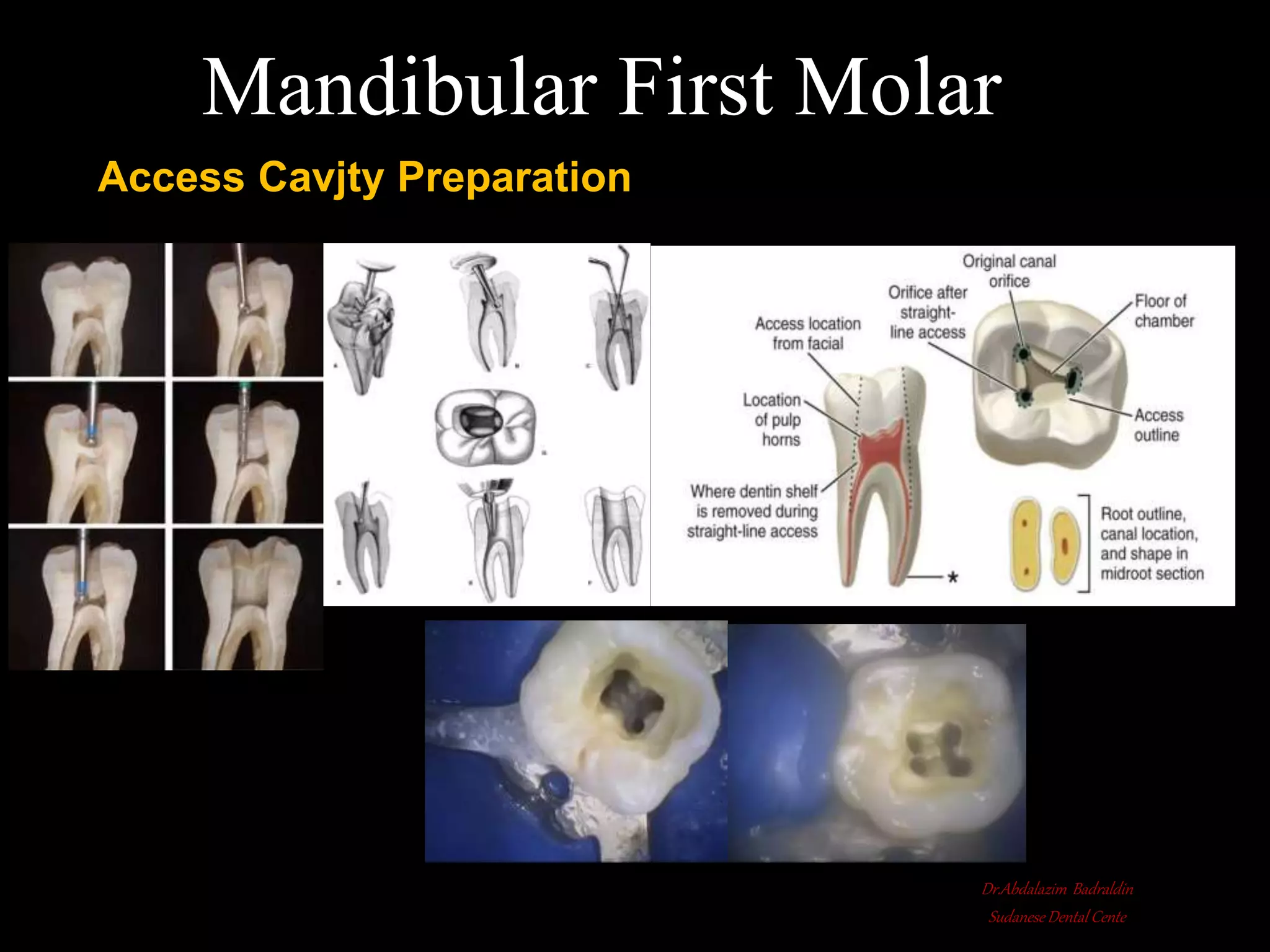 Root canal anatomy and configuration project mandibular teeth ...