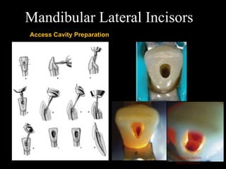 Root canal anatomy and configuration project mandibular teeth ...