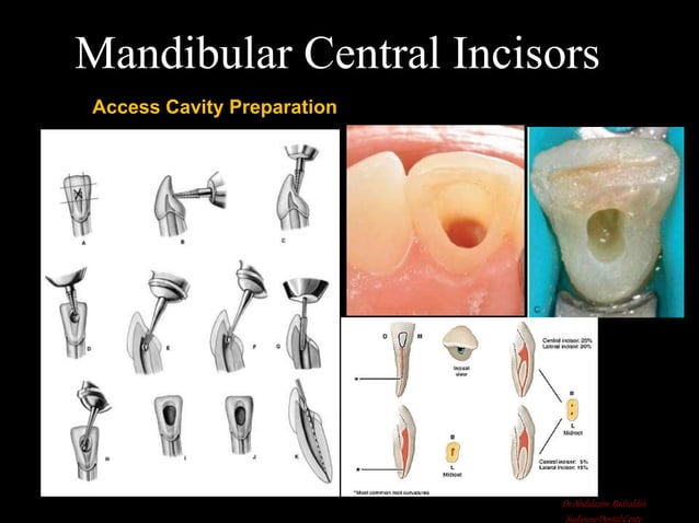 Root canal anatomy and configuration project mandibular teeth ...