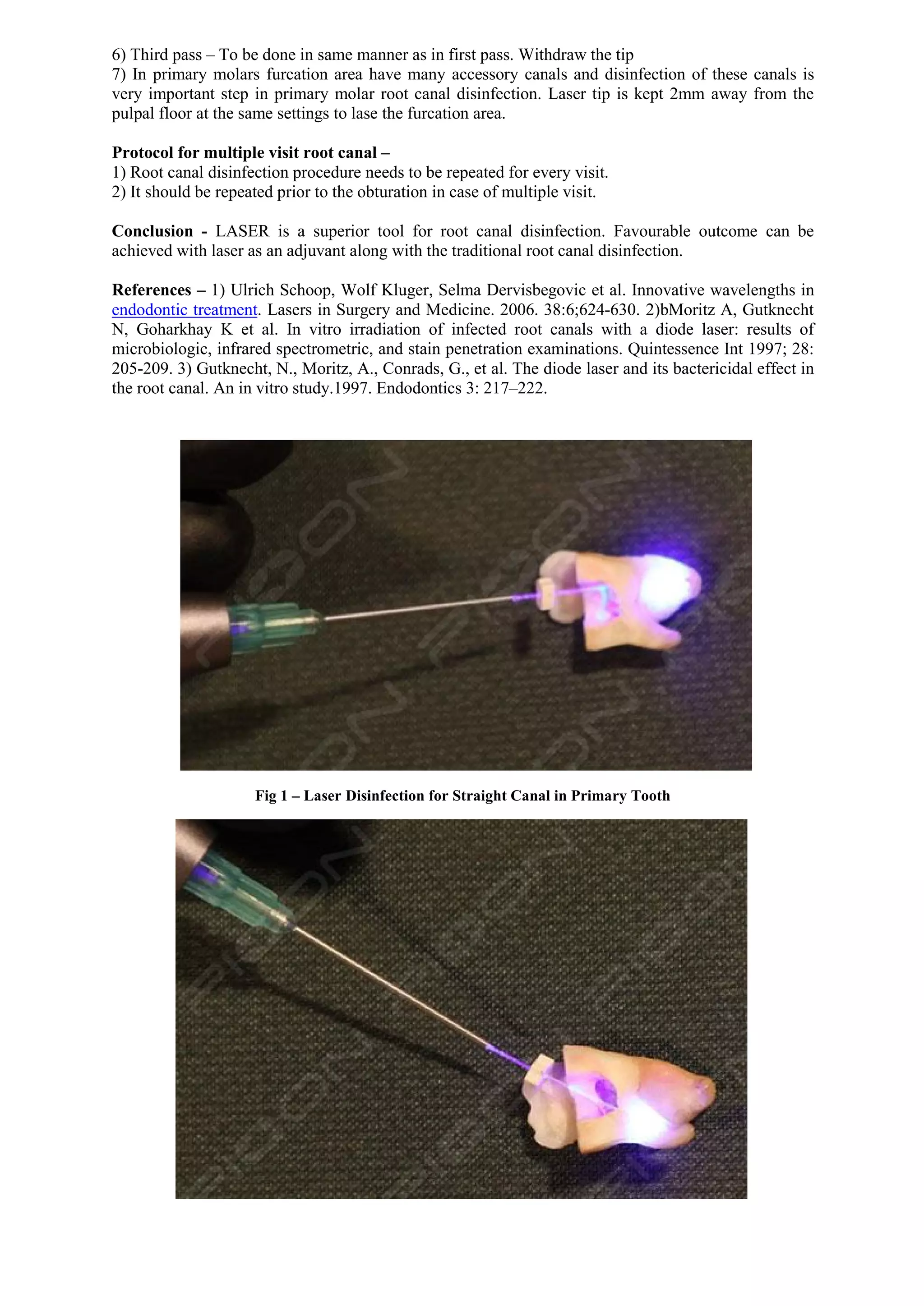 Root canal disinfection in primary molar during pulpectomy procedure ...