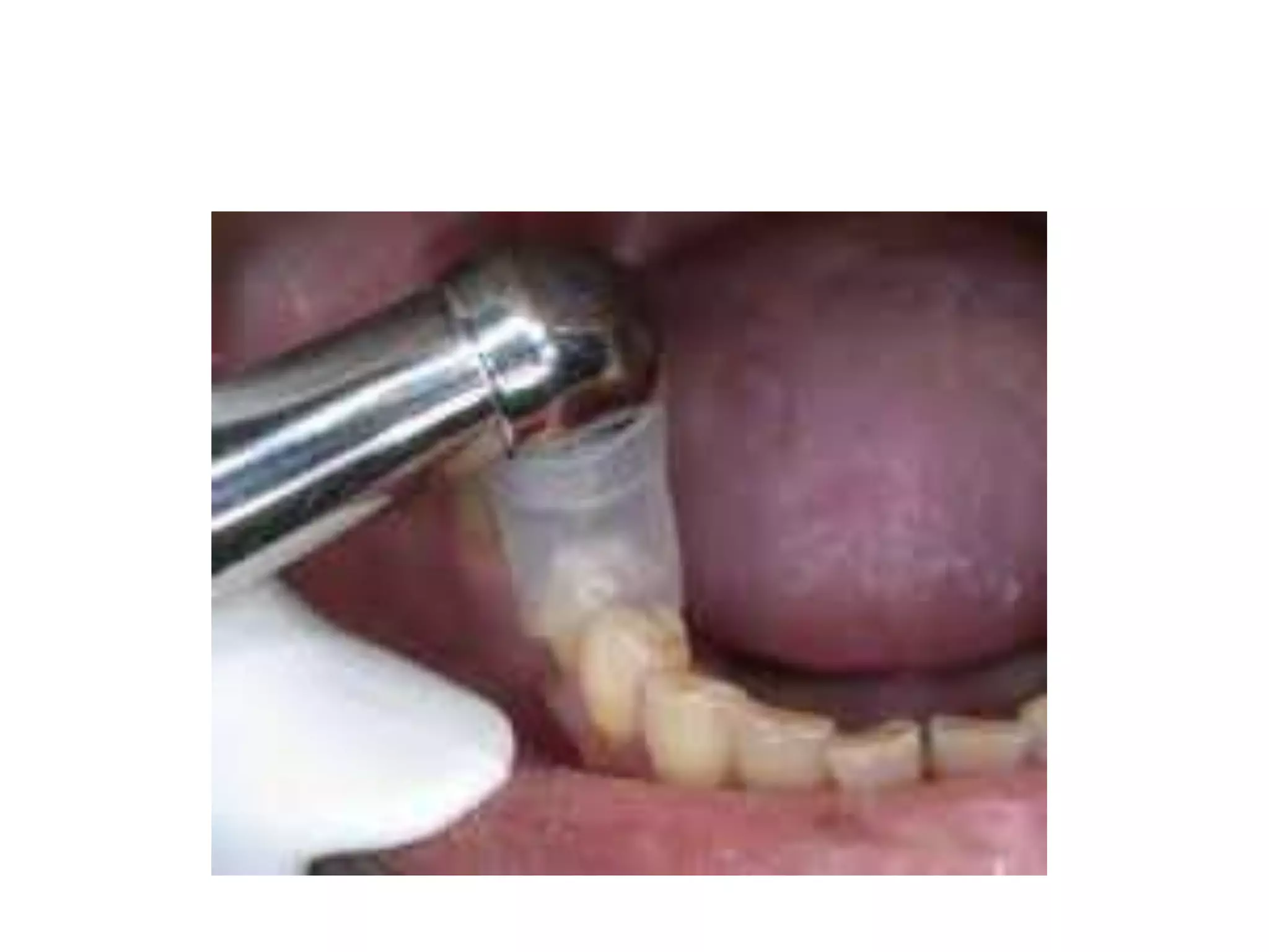 Root Canal Irrigation in RCT | PPTX