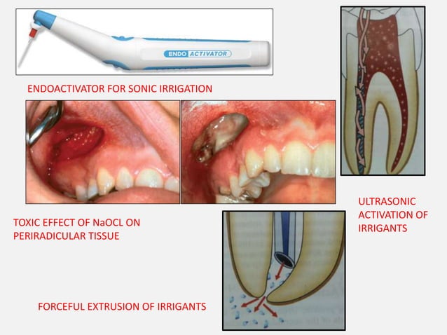 Root canal Irrigation.pptx | First Aid | Injuries