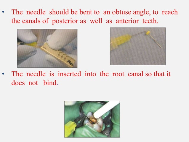 Root canal Irrigation.pptx | First Aid | Injuries