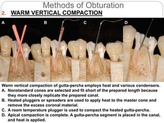 Root canal obturation timing materials and techniques | PPTX