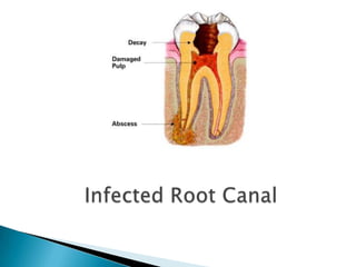 Root Canal Ppt | PPTX