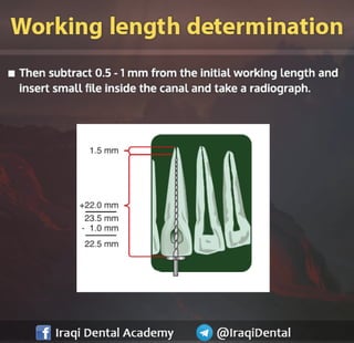Root Canal Preparation Simplified | PPT