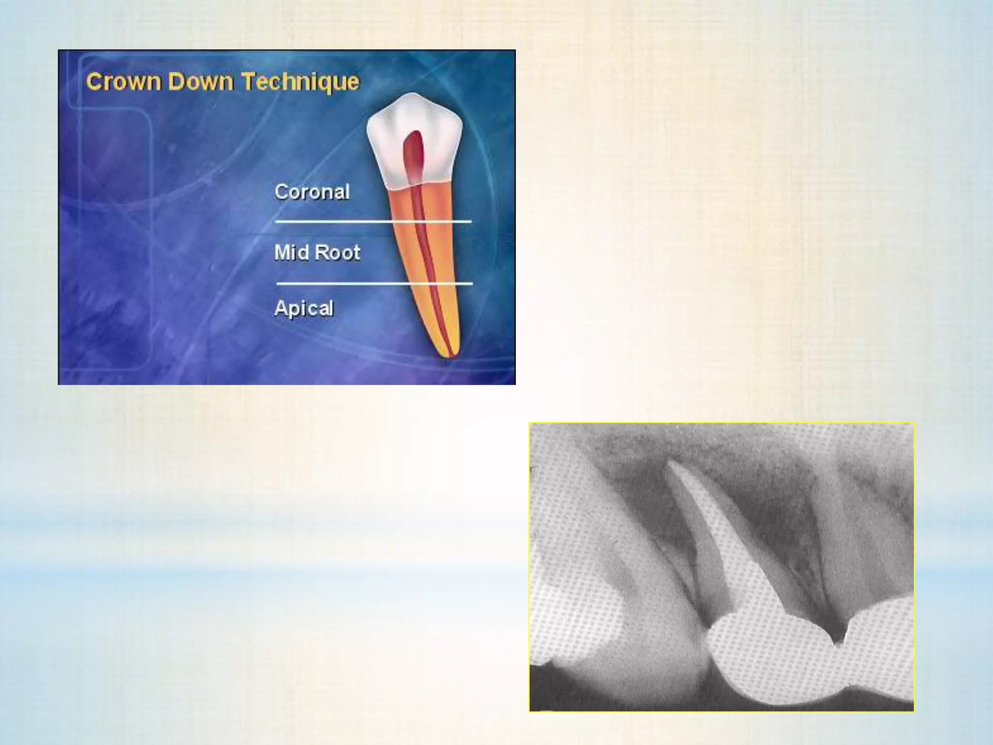 Root canal preparation techniques _ endodontic treatment | PPTX