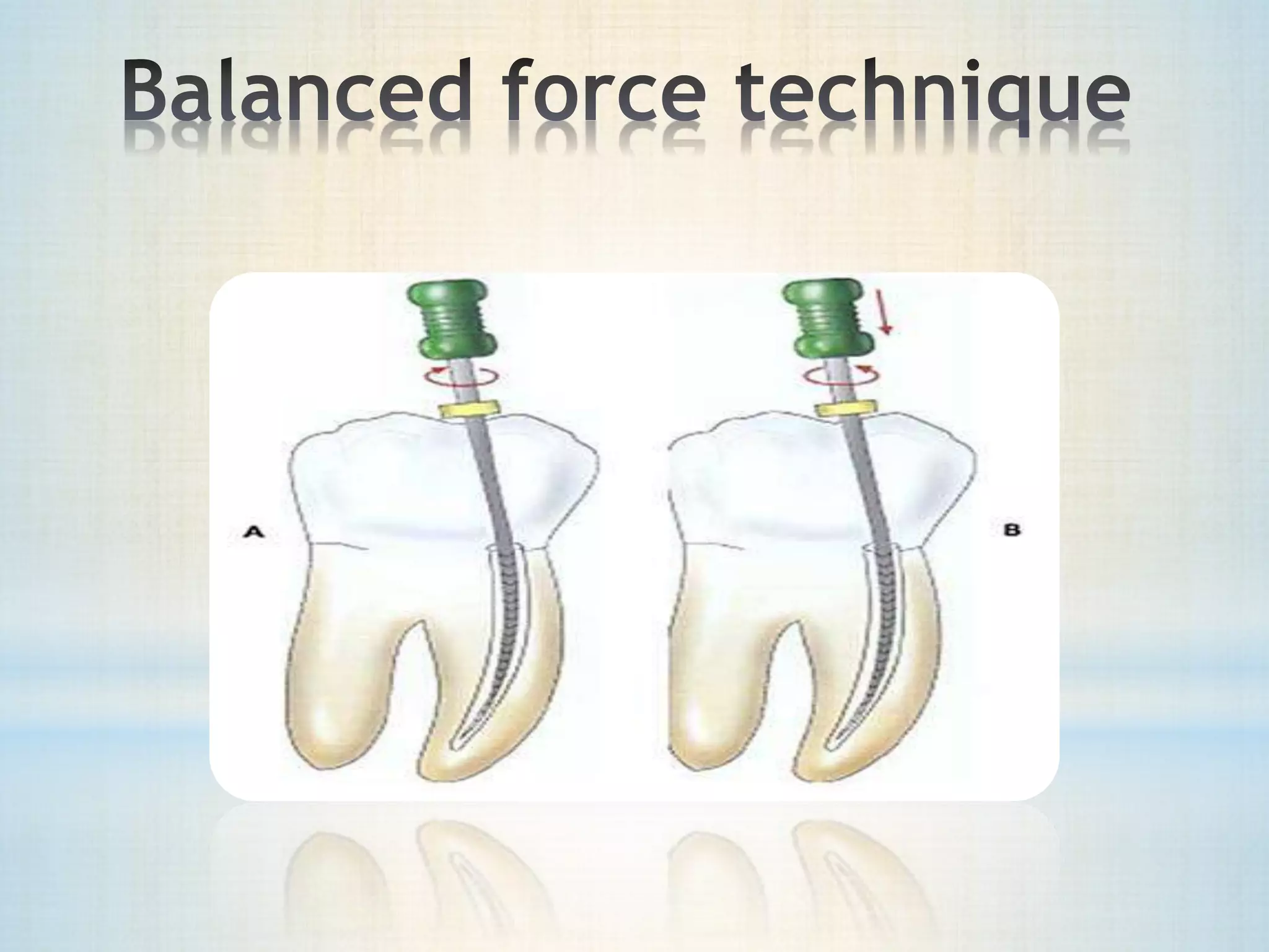 Root canal preparation techniques _ endodontic treatment | PPTX