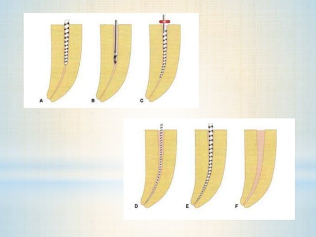 Root canal preparation techniques _ endodontic treatment | PPTX | Oral ...