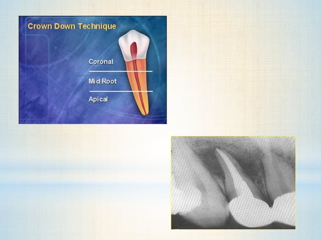 Root canal preparation techniques _ endodontic treatment | PPTX | Oral ...