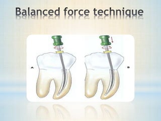 Root canal preparation techniques _ endodontic treatment | PPTX