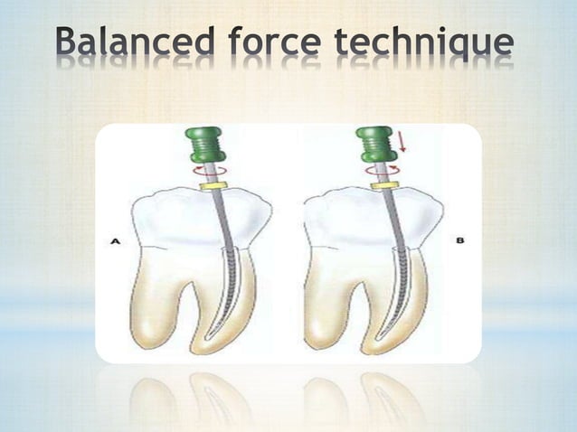 Root canal preparation techniques _ endodontic treatment | PPTX | Oral ...