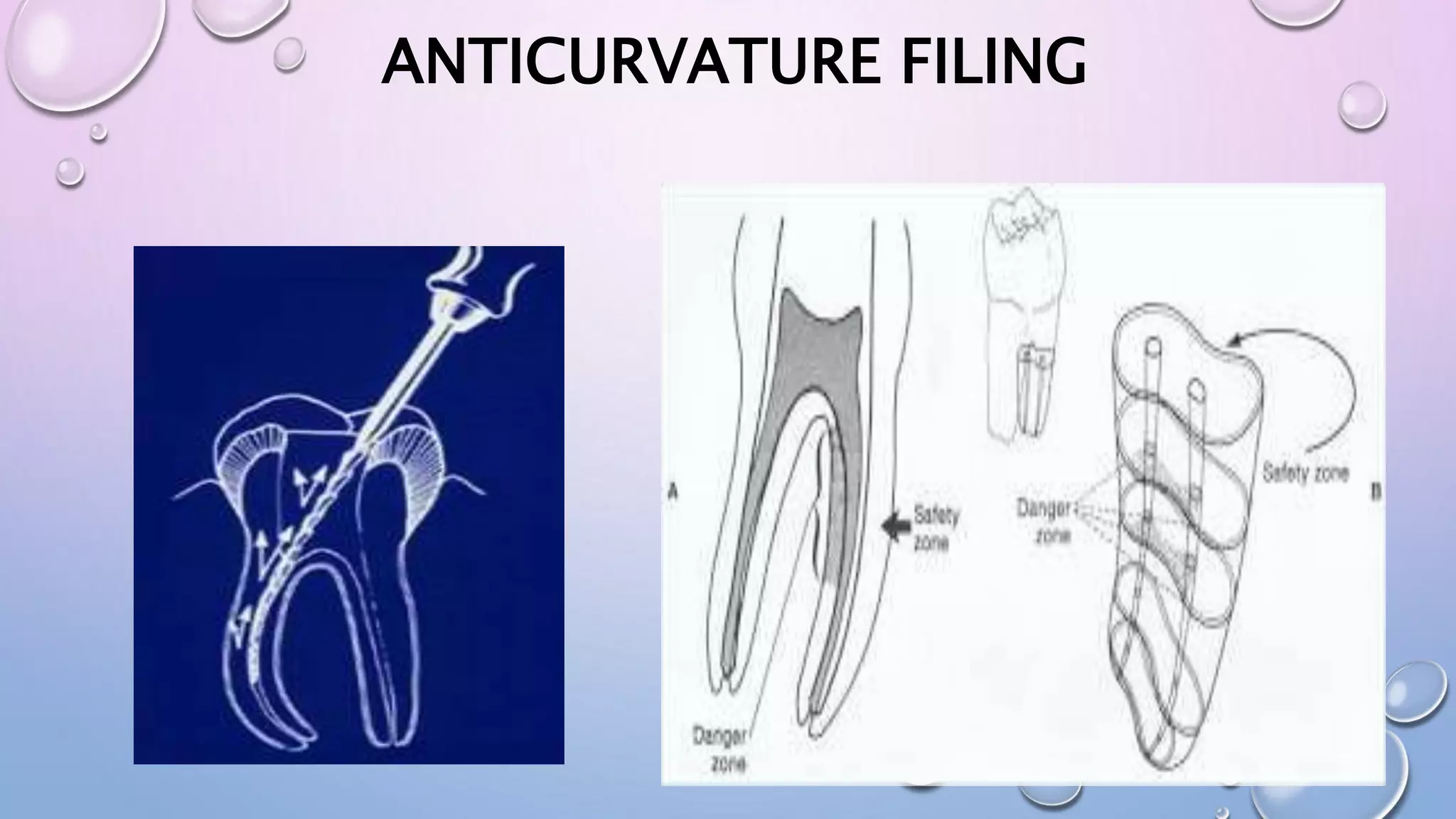 Root canal preparation techniques | PPTX