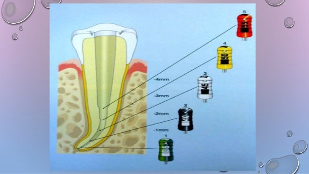 Root Canal Preparation Techniques