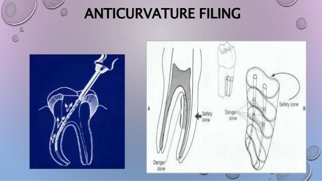 Root Canal Preparation Techniques