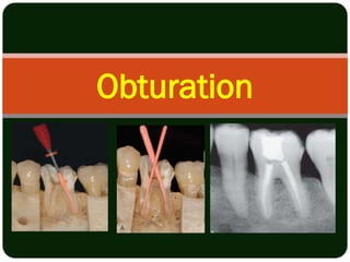 ROOT CANAL PROCEDURE.pdf
