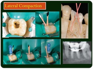 ROOT CANAL PROCEDURE.pdf