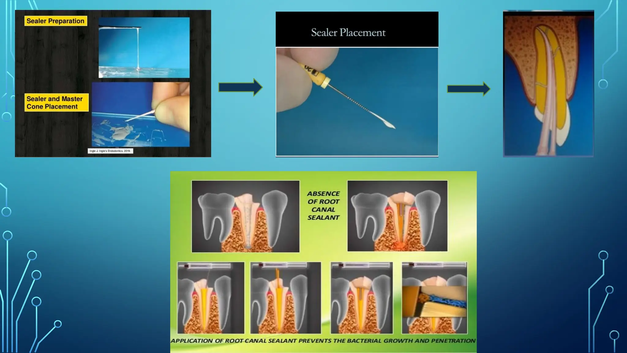 Root canal sealers.pptx definition and properties | PPTX