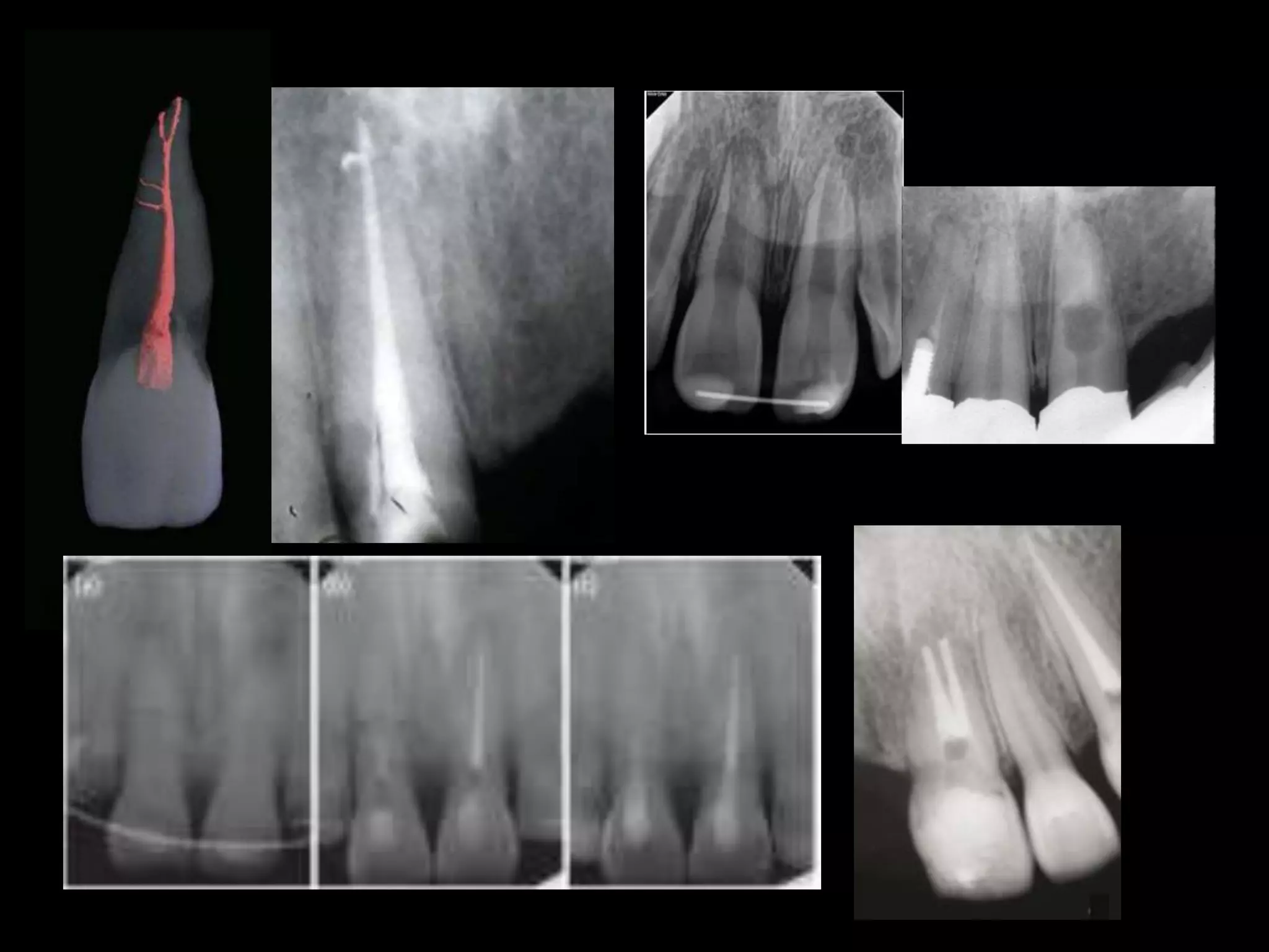 Root canals morphology and configurations - maxillary teeth | PPTX
