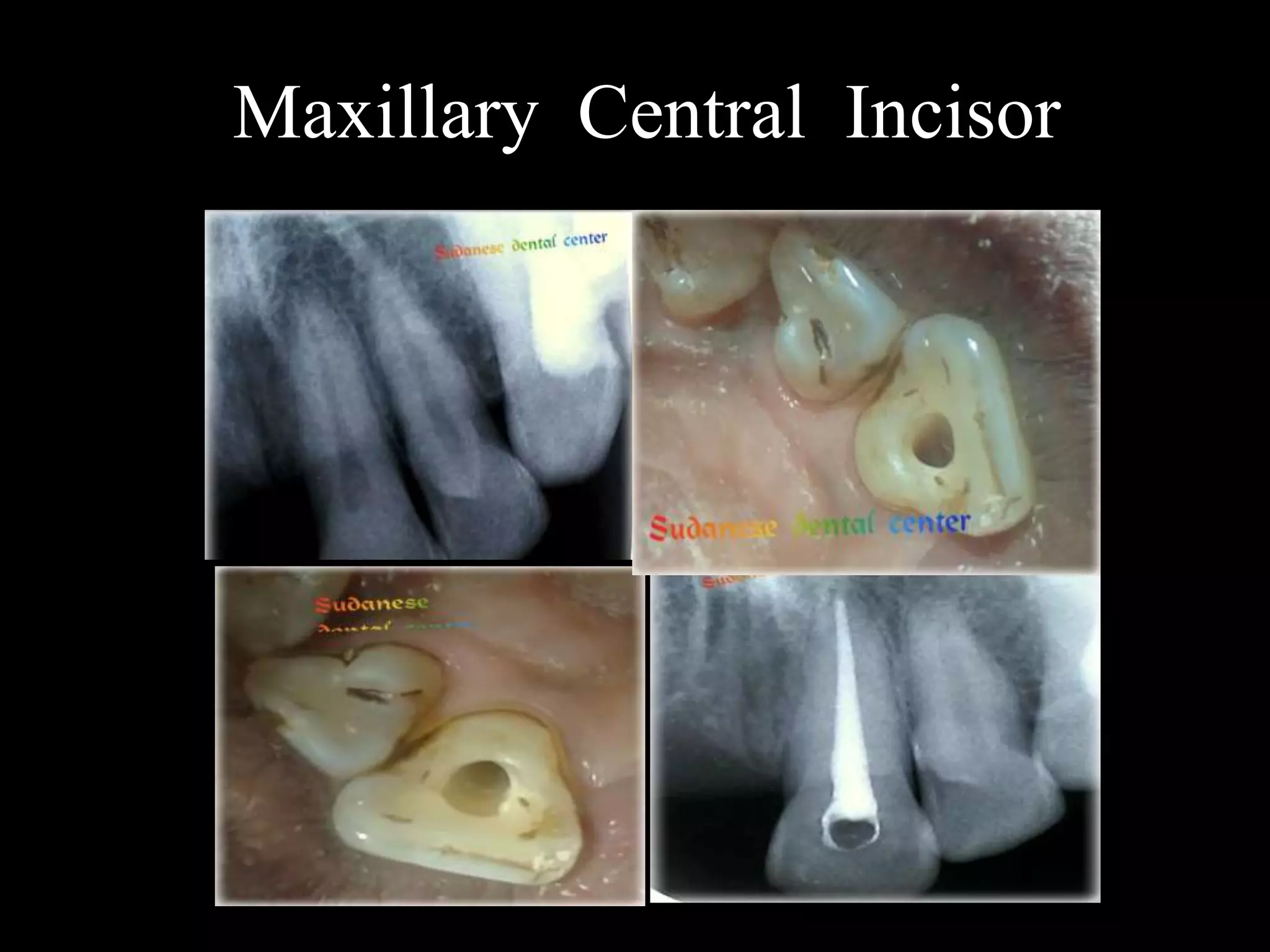 Root canals morphology and configurations - maxillary teeth | PPTX