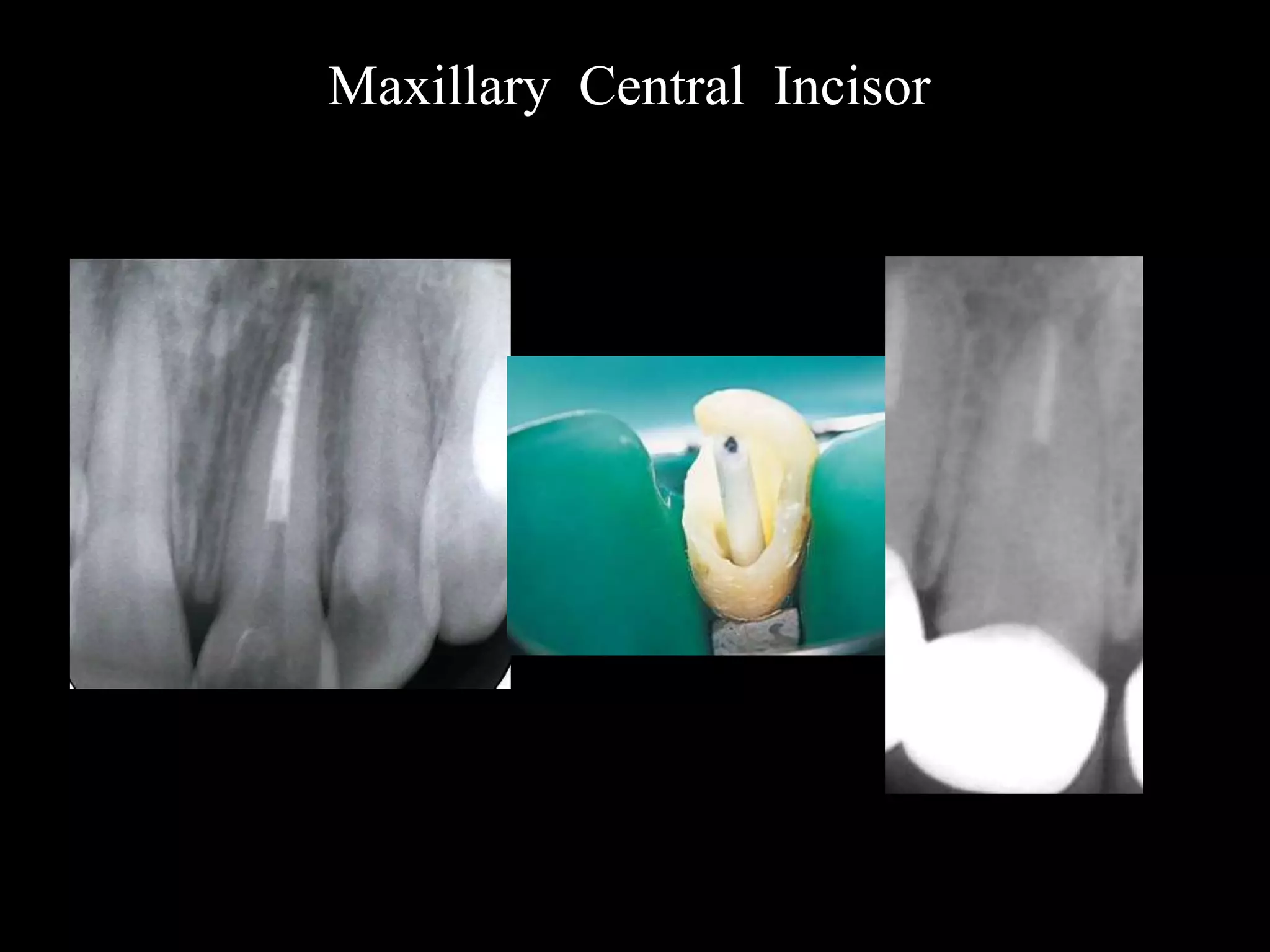 Root canals morphology and configurations - maxillary teeth | PPTX