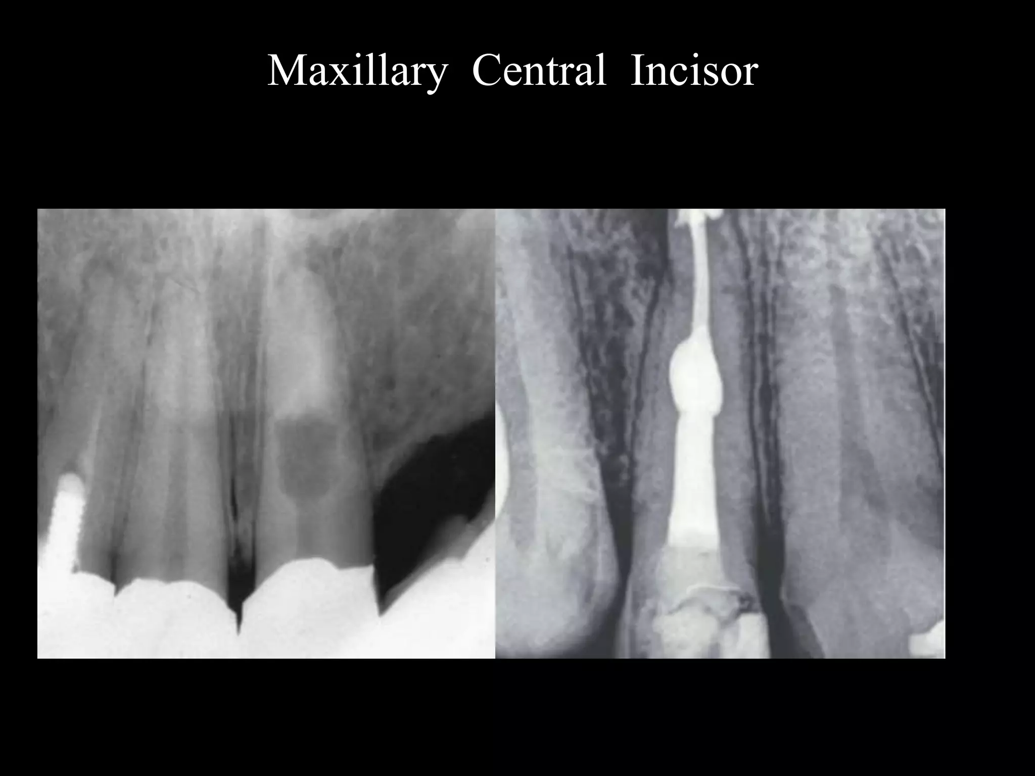 Root canals morphology and configurations - maxillary teeth | PPTX