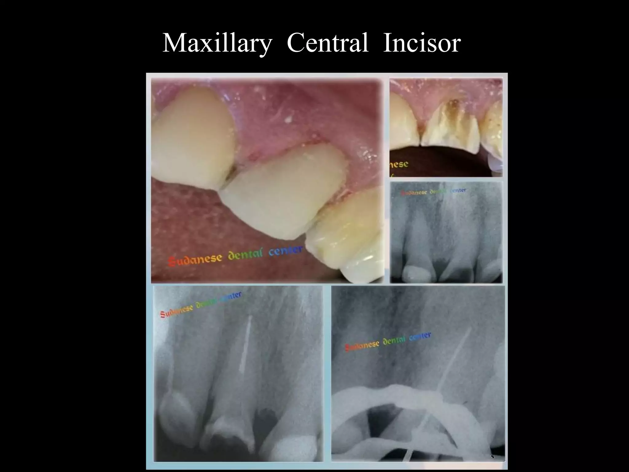 Root canals morphology and configurations - maxillary teeth | PPTX