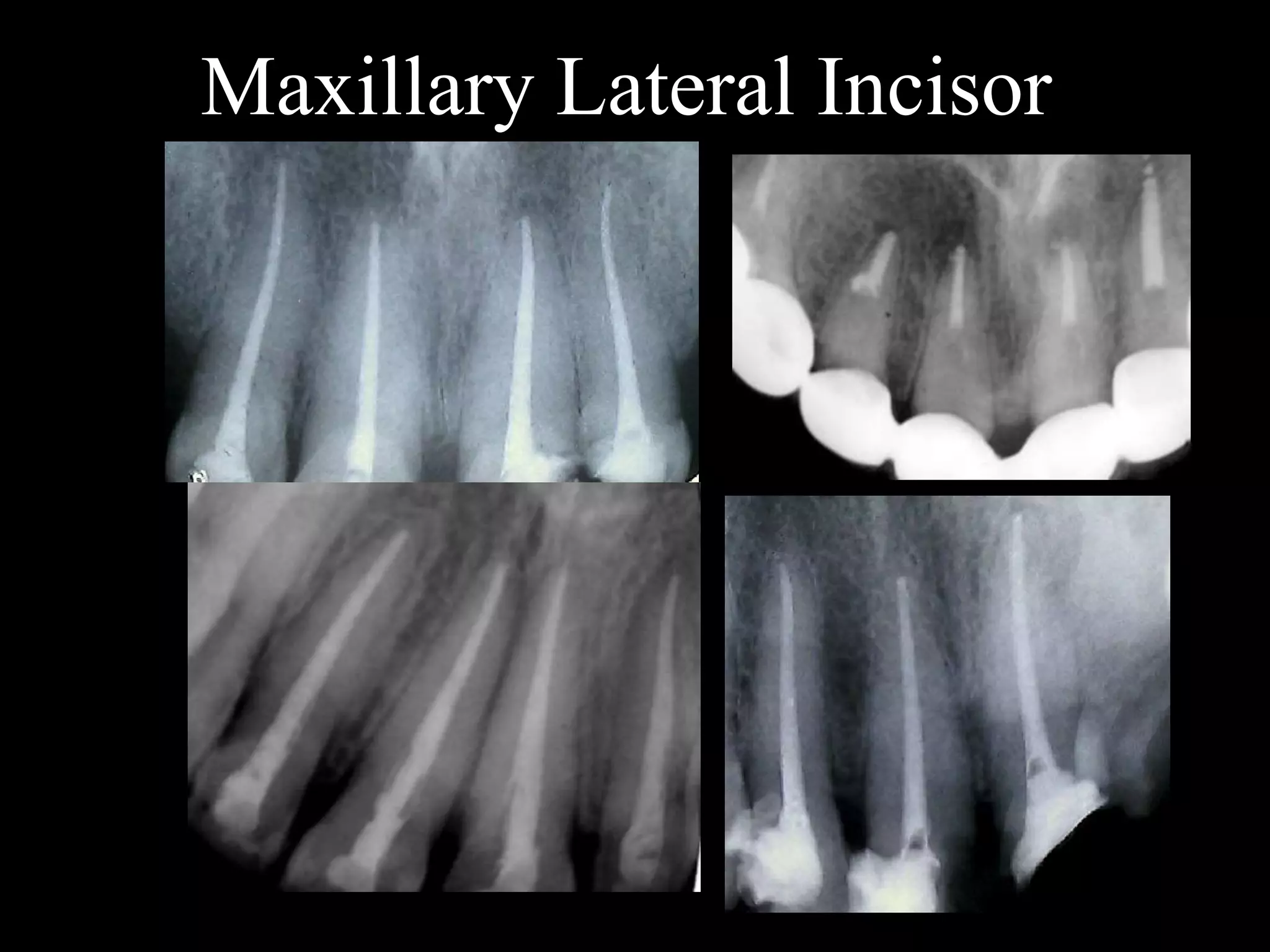 Root canals morphology and configurations - maxillary teeth | PPTX