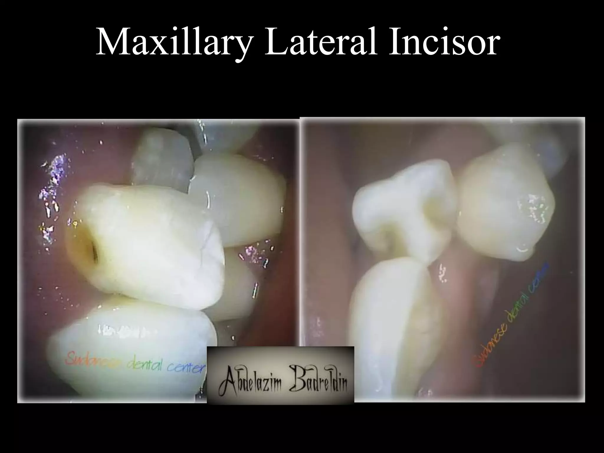 Root canals morphology and configurations - maxillary teeth | PPTX
