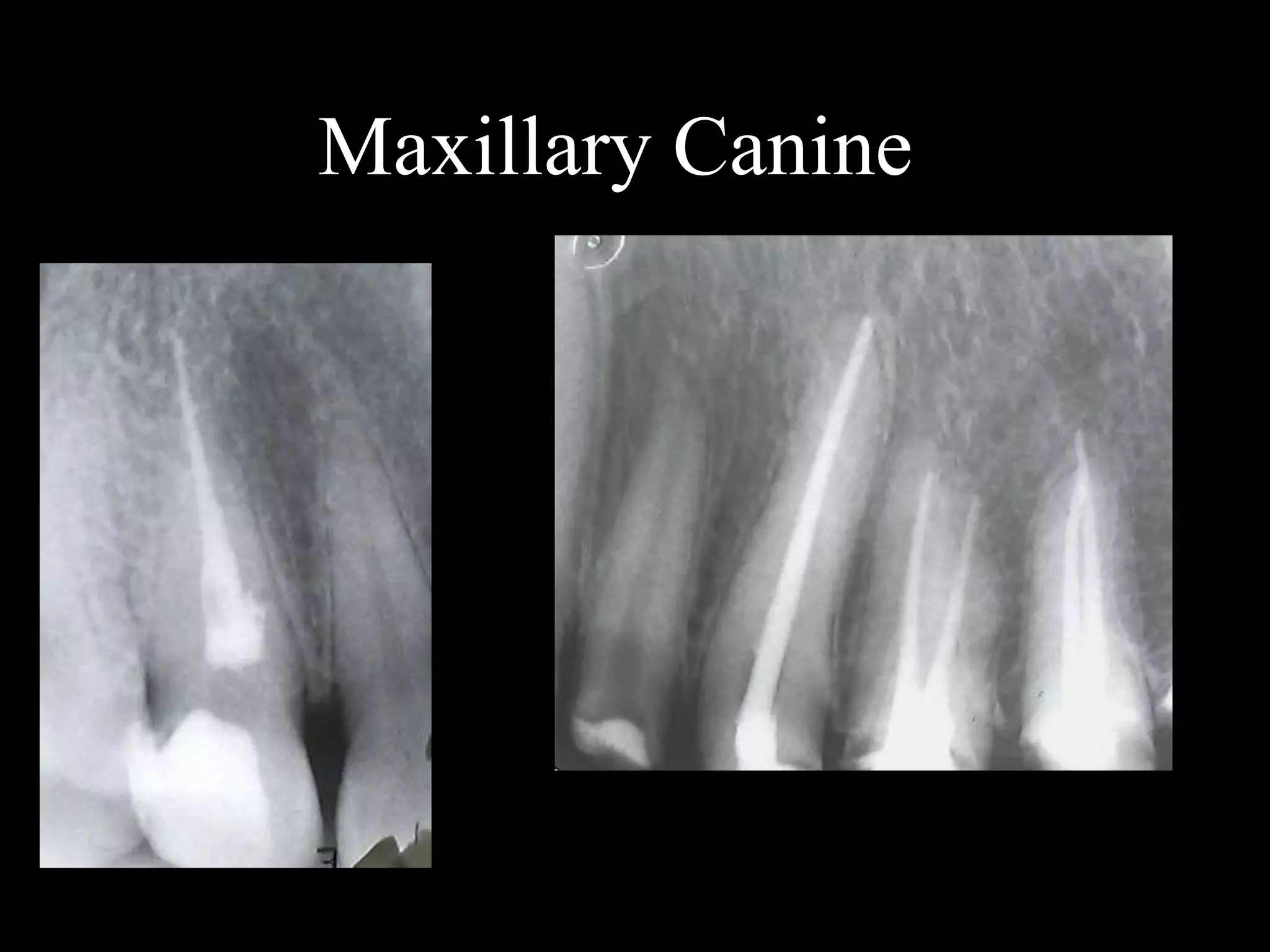 Root canals morphology and configurations - maxillary teeth | PPTX