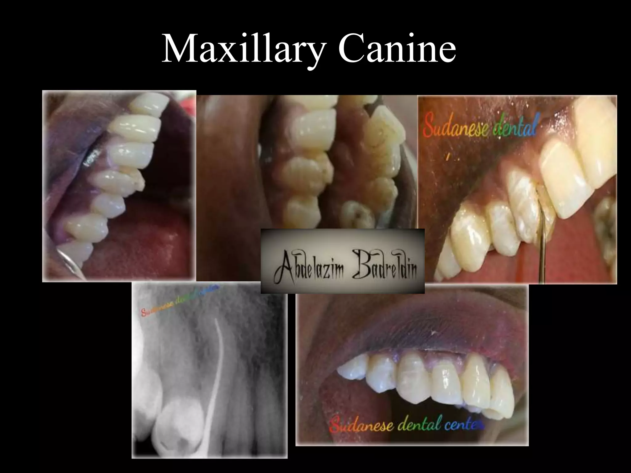 Root canals morphology and configurations - maxillary teeth | PPTX