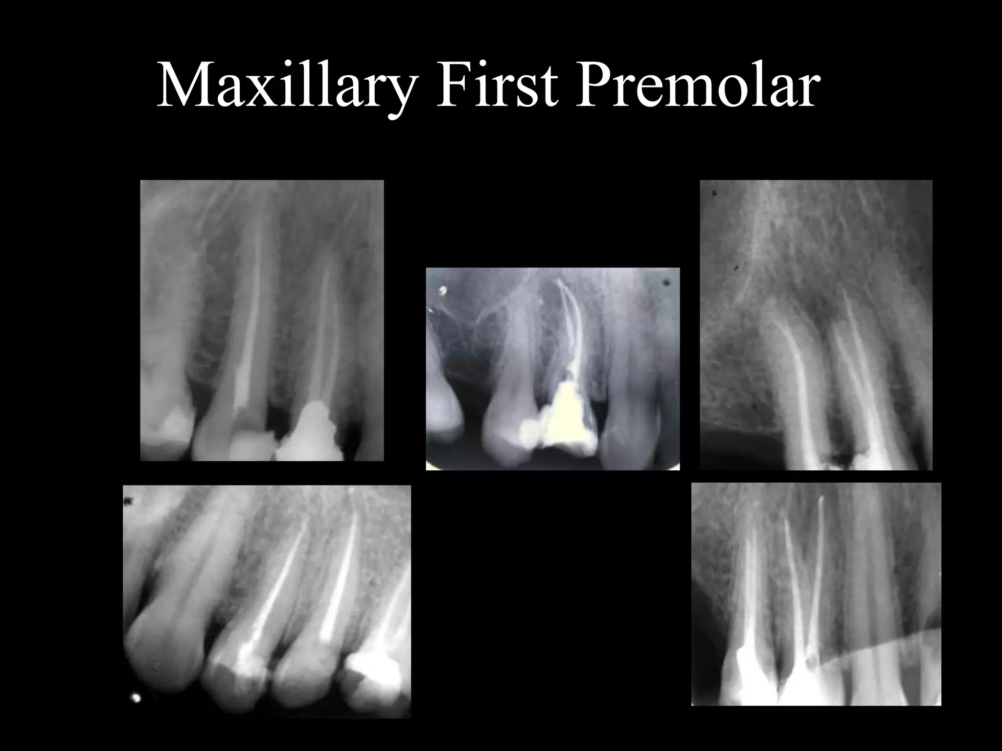 Root canals morphology and configurations - maxillary teeth | PPTX