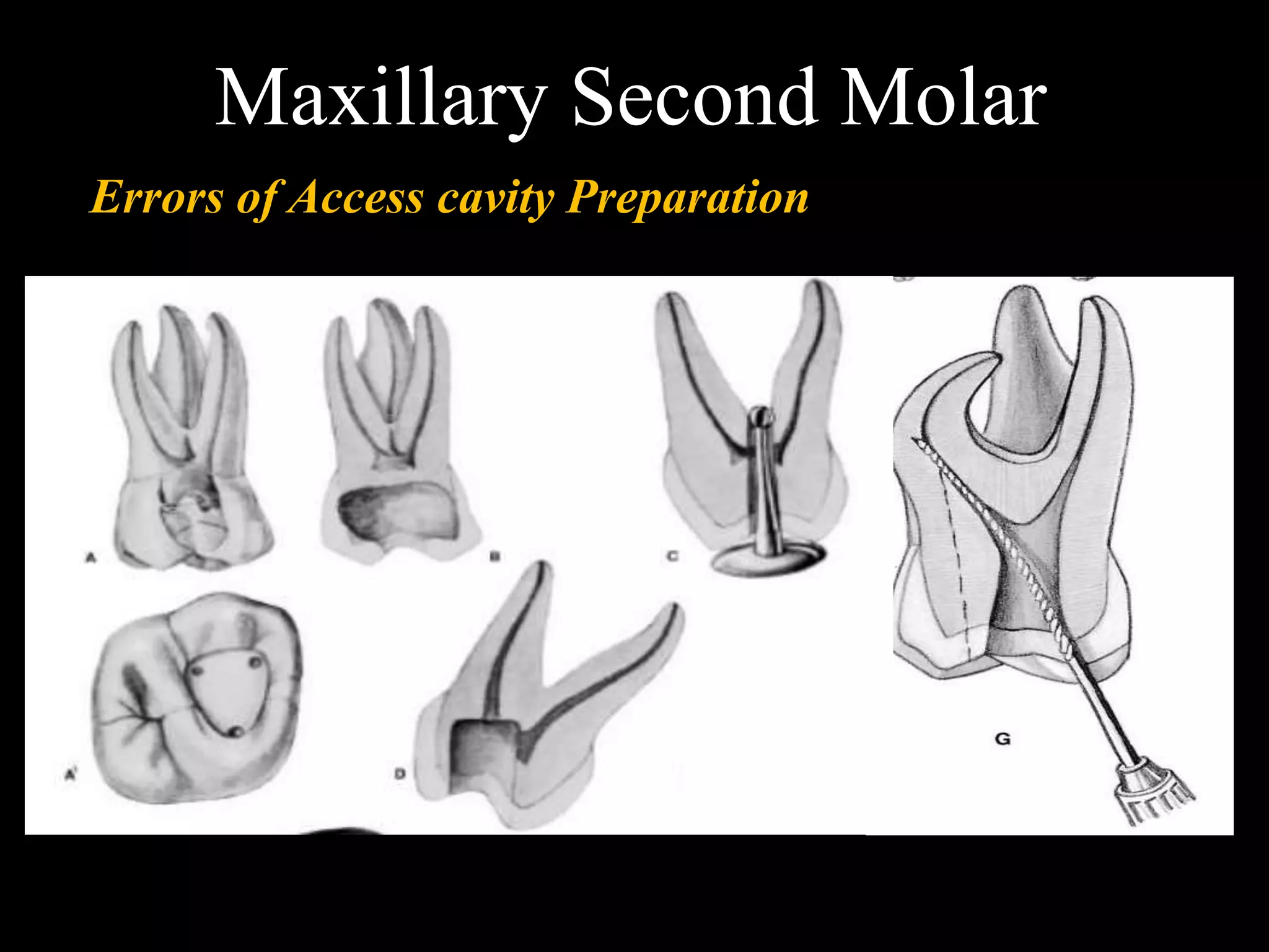 Root canals morphology and configurations - maxillary teeth | PPTX