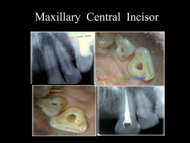 Root canals morphology and configurations - maxillary teeth | PPTX ...