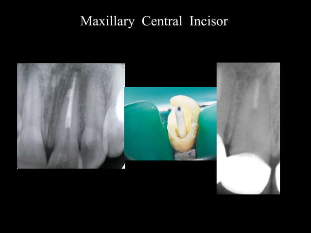 Root canals morphology and configurations - maxillary teeth | PPTX ...