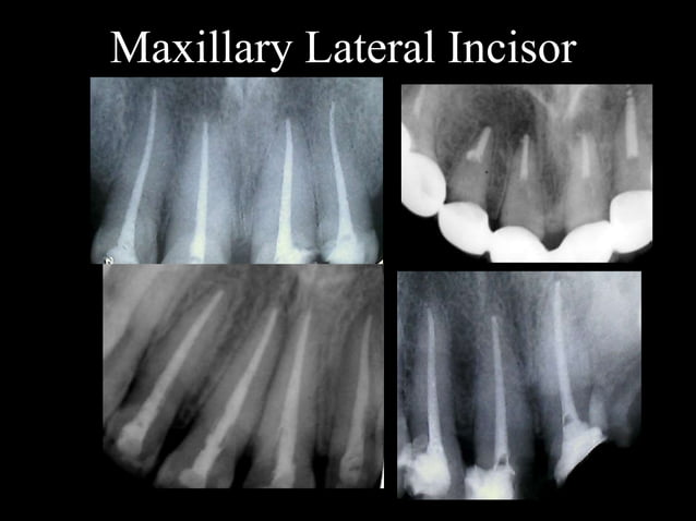 Root canals morphology and configurations - maxillary teeth | PPTX ...
