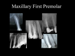 Root canals morphology and configurations - maxillary teeth | PPTX