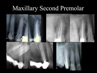 Root canals morphology and configurations - maxillary teeth | PPTX