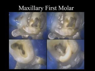 Root canals morphology and configurations - maxillary teeth | PPTX