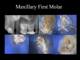 Root canals morphology and configurations - maxillary teeth | PPTX