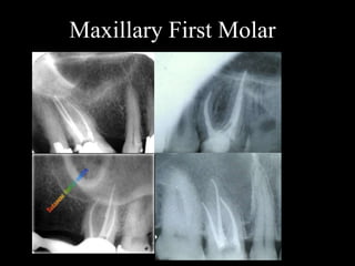 Root canals morphology and configurations - maxillary teeth | PPTX