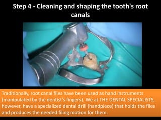 Root canal treatment | PDF