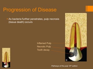 Root Canal Treatment | PDF
