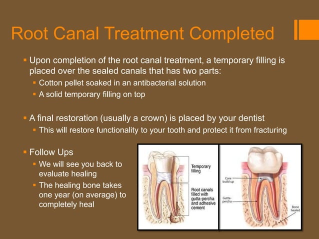 Root Canal Treatment | PDF