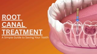 Complete Overview of Root Canal Procedure | PDF