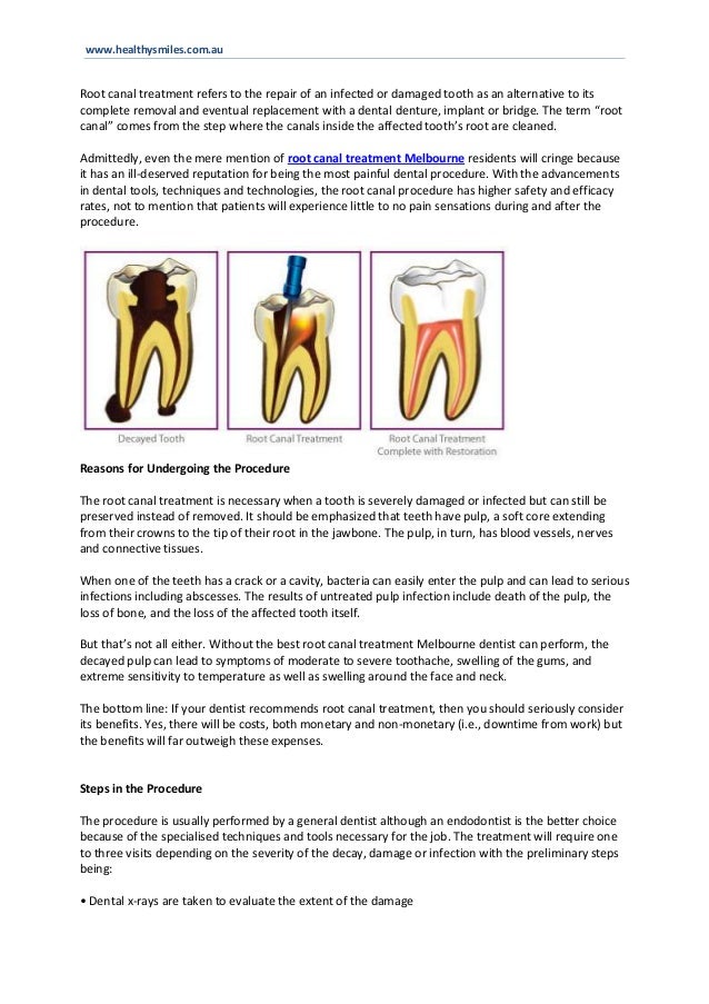 Root Canal Treatment A Step By Step Patient Guide