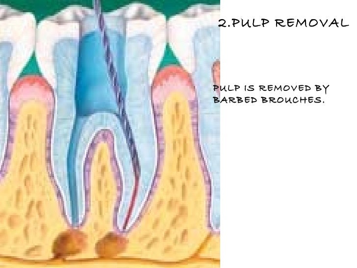 Root Canal Treatment